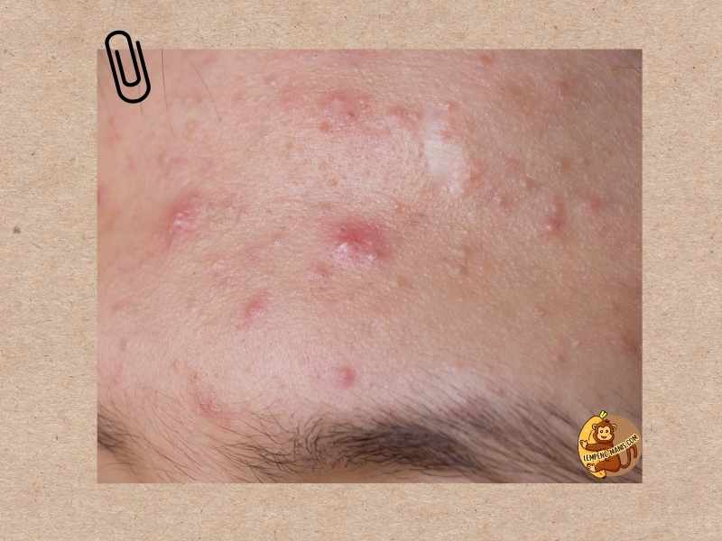 √kenali Jenis-jenis Jerawat, Jangan Sampai Salah Langkah - lempeng ...